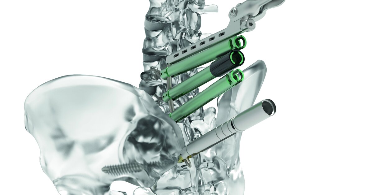 ulrich medical élargit uCentum et uBase pour offrir plus d'options MIS