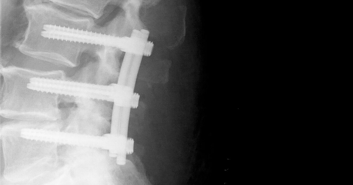 Study: Dynamic spinal stabilization vs. fusion
