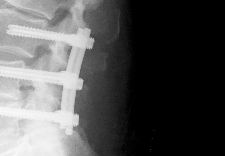 Implants for spinal surgery from ulrich medical