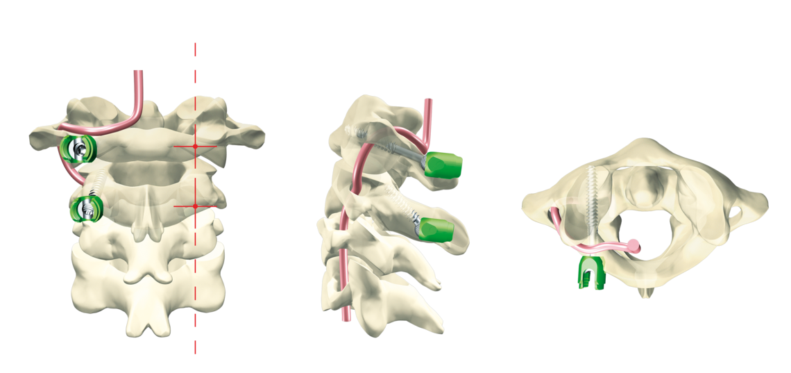 neon³™ – Occipitocervical screw-rod system