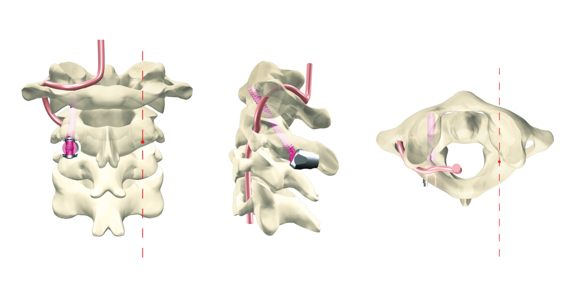 neon³™ – Occipitocervical screw-rod system