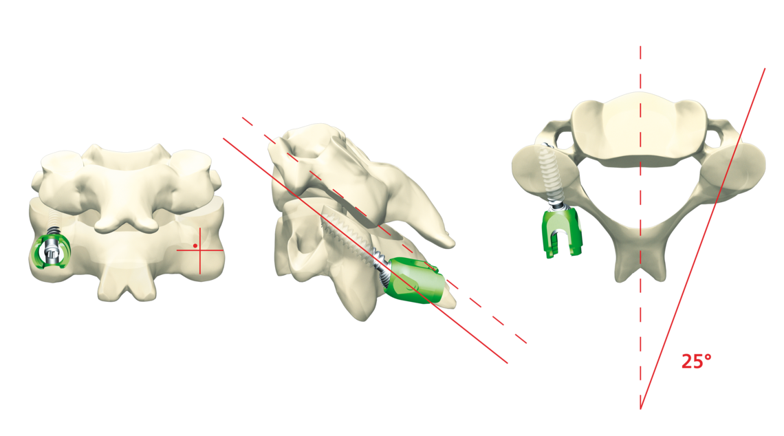neon³™ – Occipitocervical screw-rod system