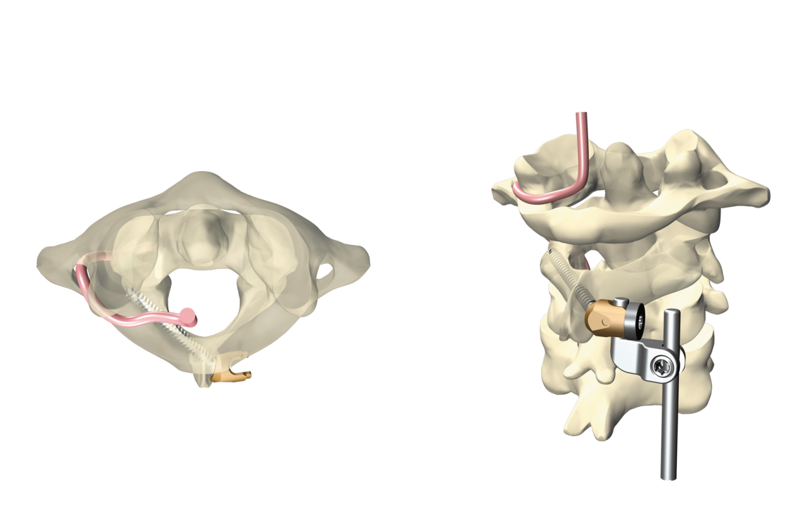 neon³™ – Occipitocervical screw-rod system