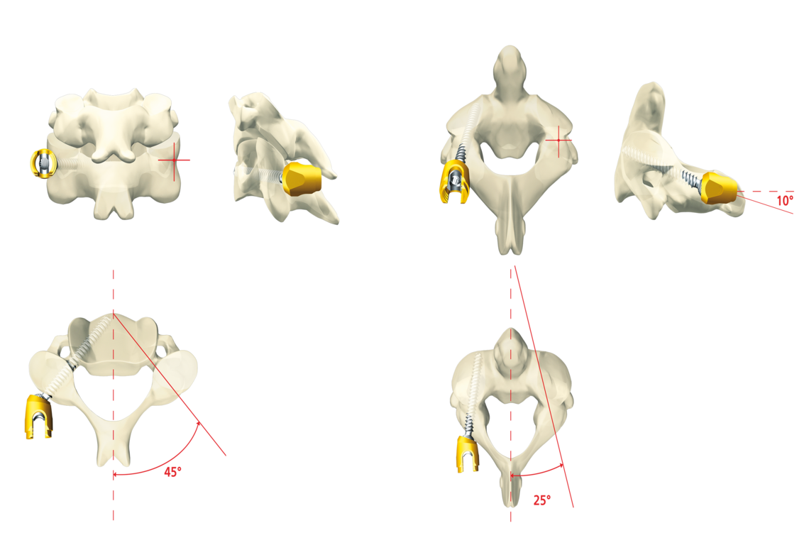 neon³™ – Occipitocervical screw-rod system