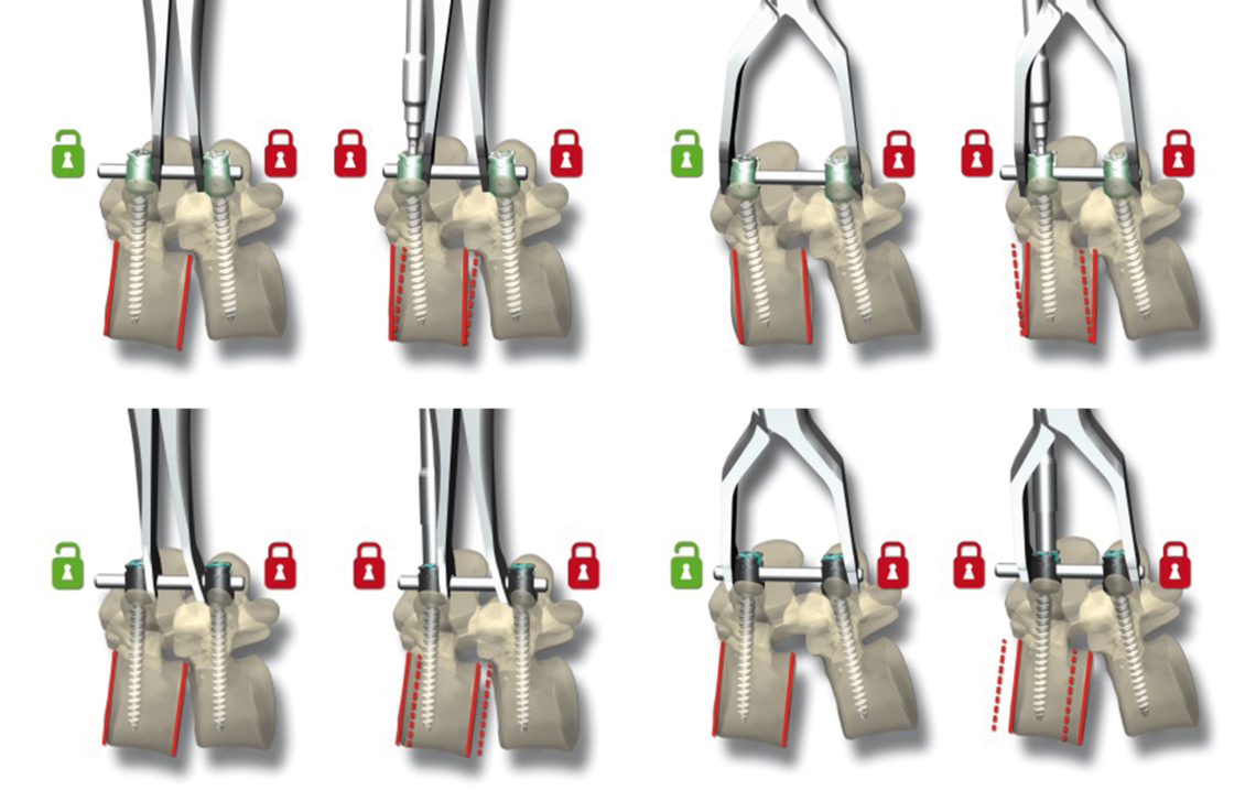 uCentum™ – Thorakolumbosakrales Stab-Schrauben-System