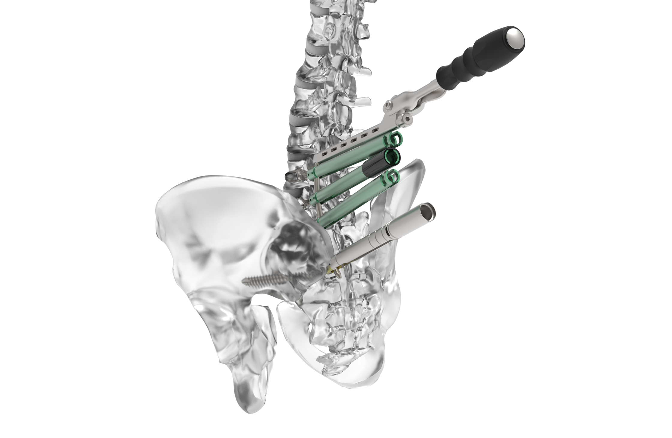 uCentum™ – Thoracolumbosacral screw-rod system