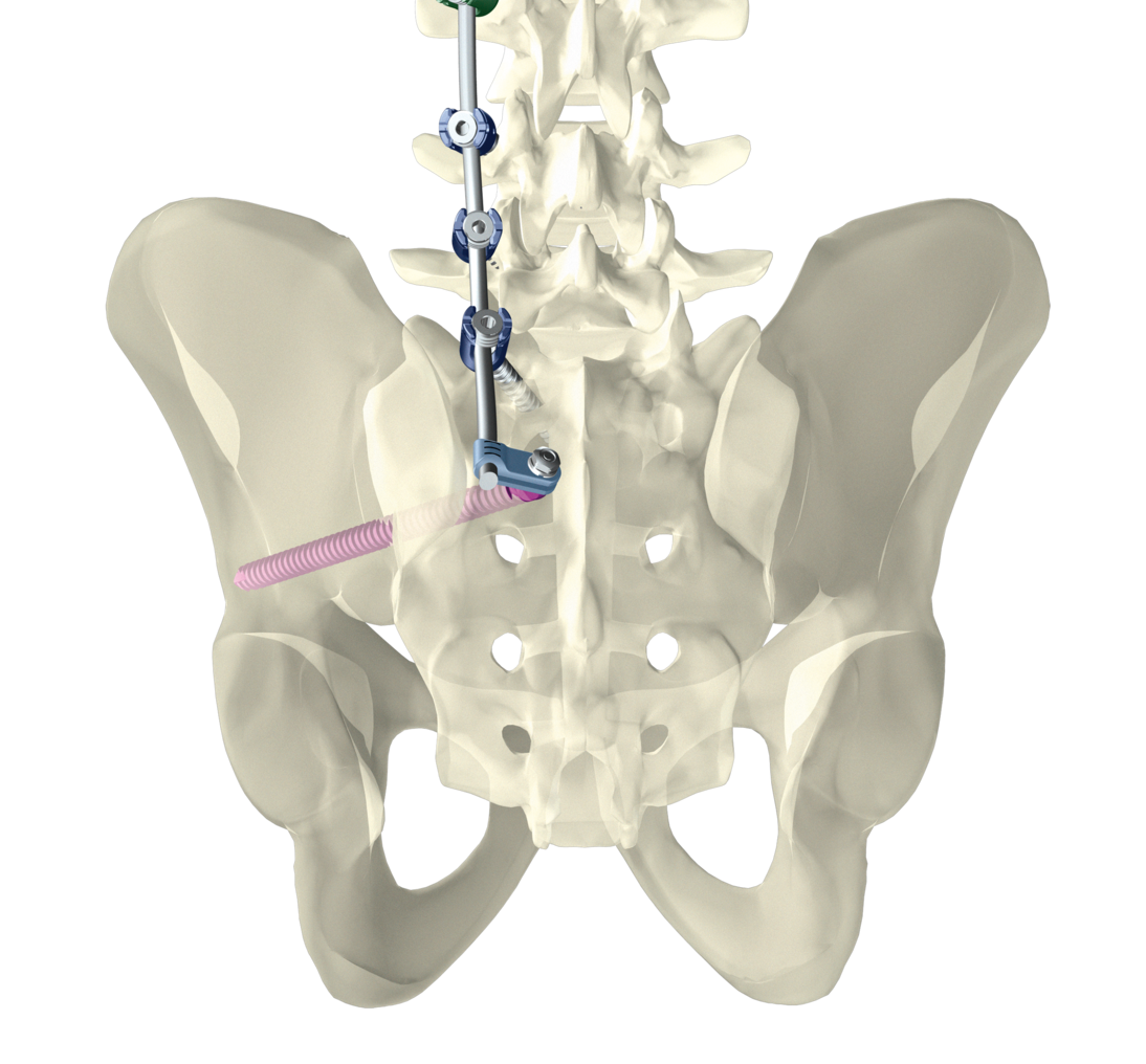 uBase™ – Iliosacral screw-rod system