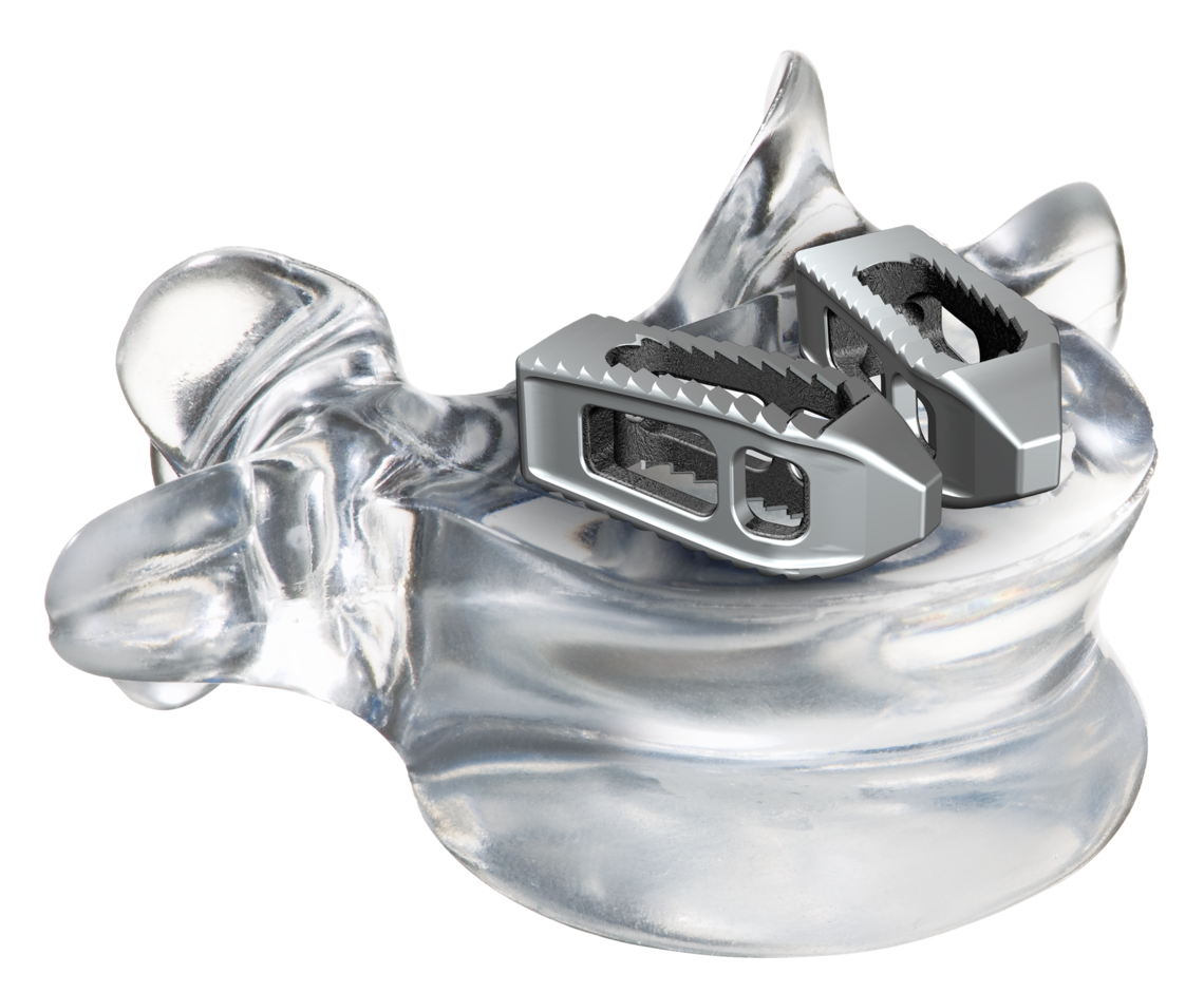 tezo™ – titanium cage family