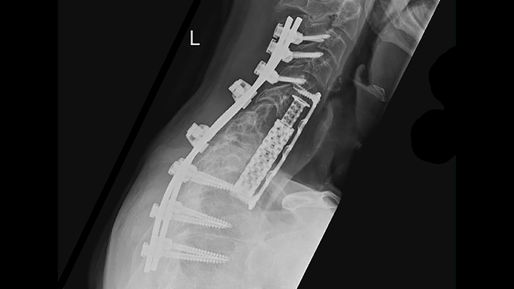 Implantes para la cirugía columna vertebral de ulrich medical