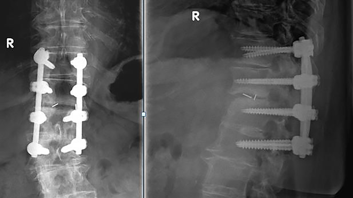 Implantes para la cirugía columna vertebral de ulrich medical
