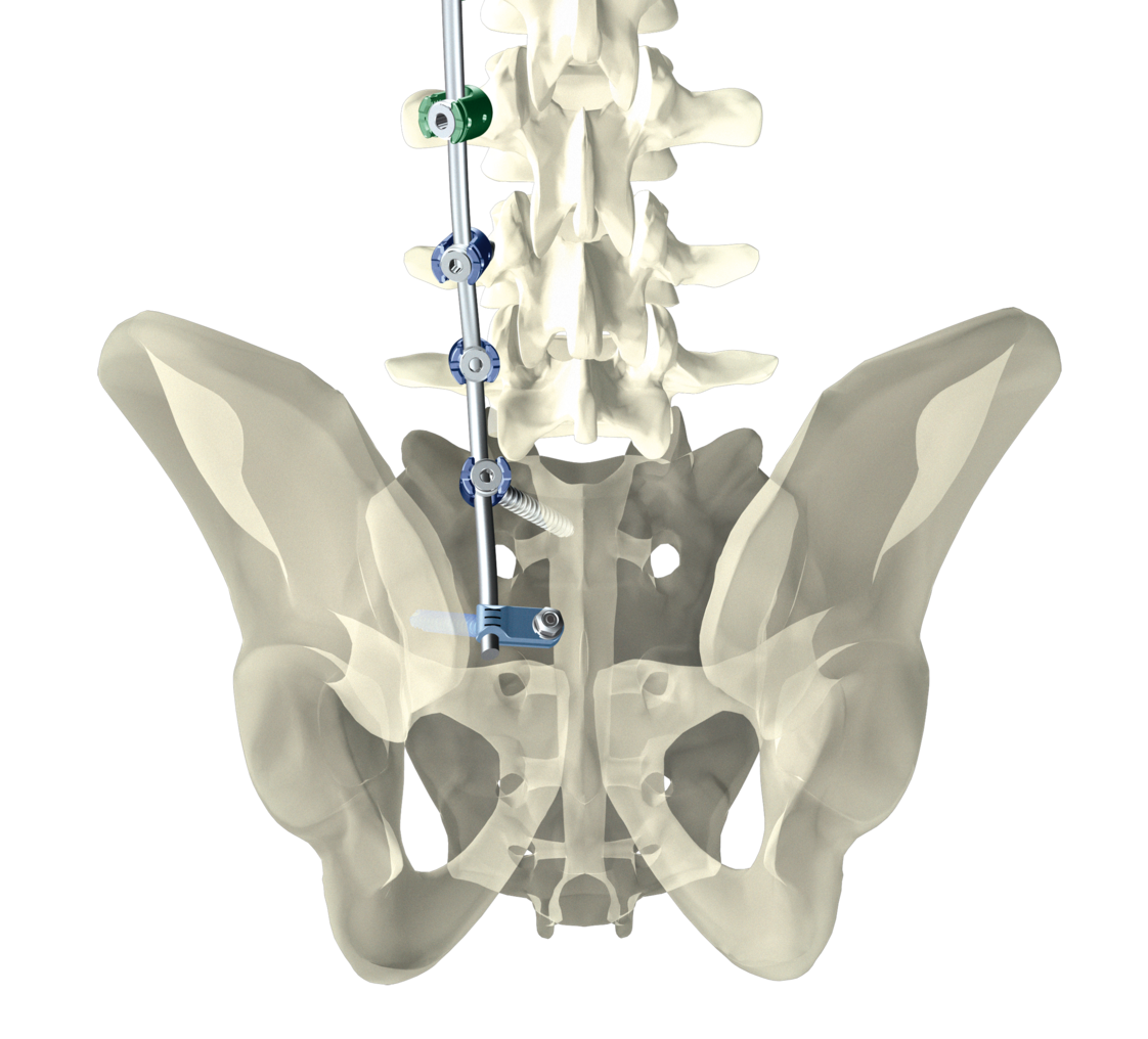 uBase™ – Sistema de varilla-tornillo iliosacro