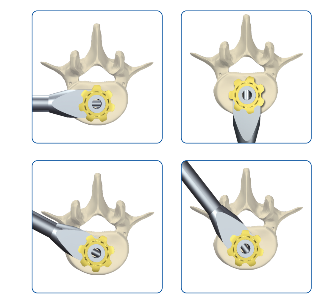 obelisc™ – Distrahierbarer Wirbelkörperersatz